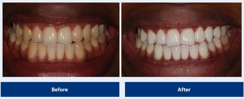 Philips Zoom! Whitening - Providing NHS and Private Dentistry